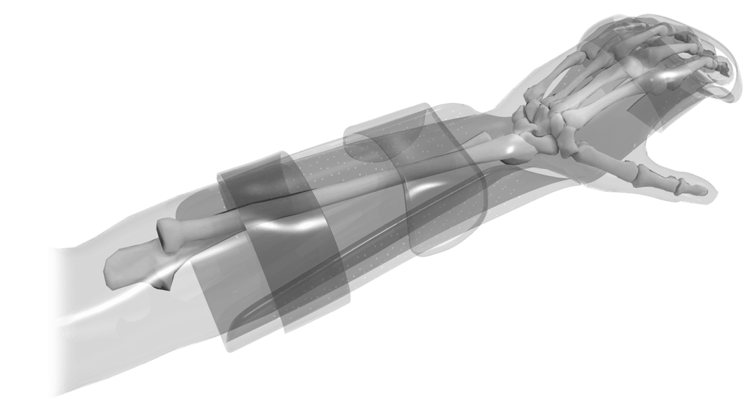 CHRISOFIX TECHNOLOGY - Chrisofix World-Class Ortheses